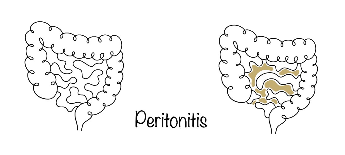 Peritoneum Vector Images (over 100)