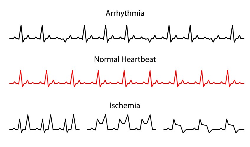 Arrhythmia Vector Images (over 850)