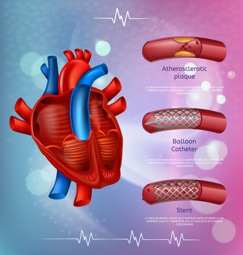 Stent Vector Images (over 170)