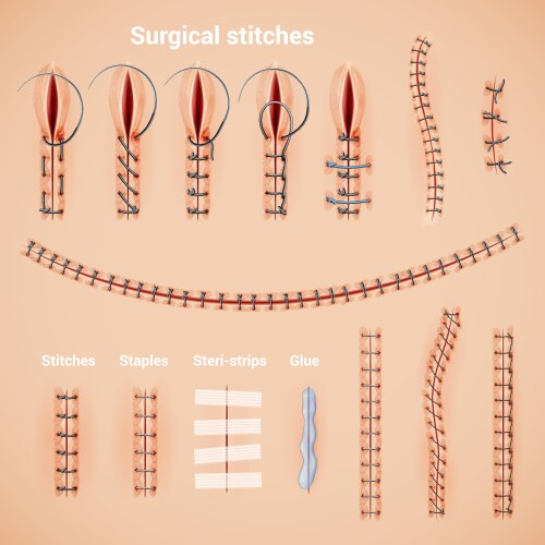 Surgical stitches infographic set Royalty Free Vector Image