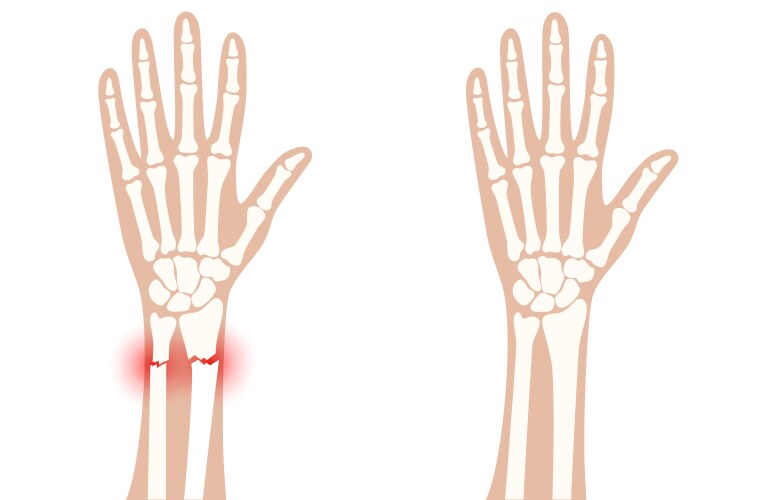 Fracture x ray concept Royalty Free Vector Image