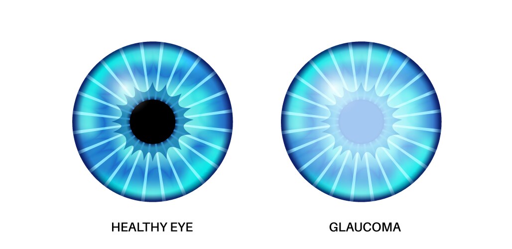 Glaucoma eye disease Royalty Free Vector Image