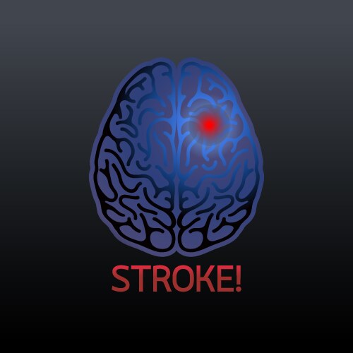 Brain stroke ishemic and hemorrhagic Royalty Free Vector