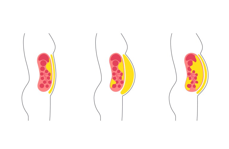 Internal Organs Obesity Vector Images (over 610)