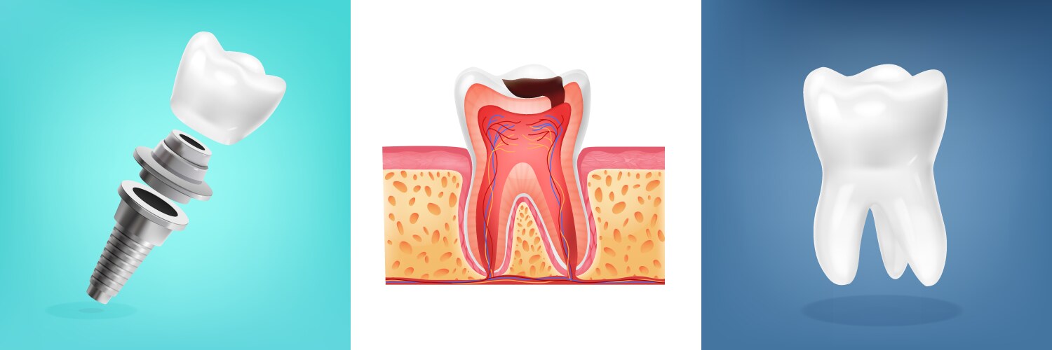 Realistic caries tooth anatomy Royalty Free Vector Image