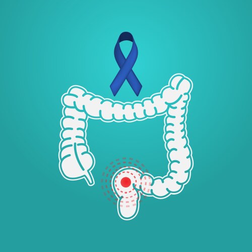 Colon Cancer Vector Images (over 1,900)