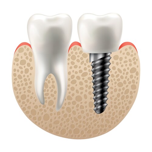 Implant Vector Images (over 26,000)