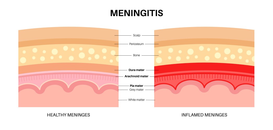 Meningitis medical poster Royalty Free Vector Image
