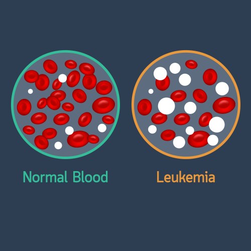 Leukemia vs. Normal Blood Royalty Free Vector Image