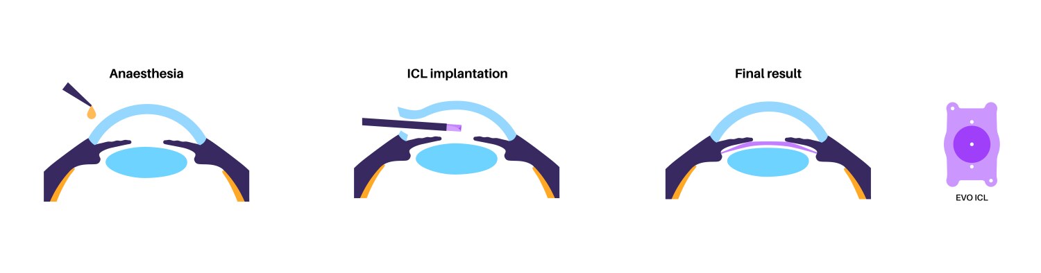 Vitrectomy surgical poster Royalty Free Vector Image