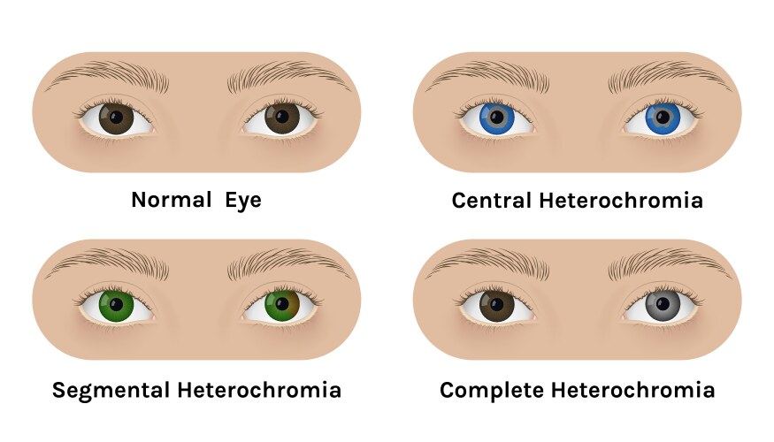 Realistic human eyes with polycoria Royalty Free Vector