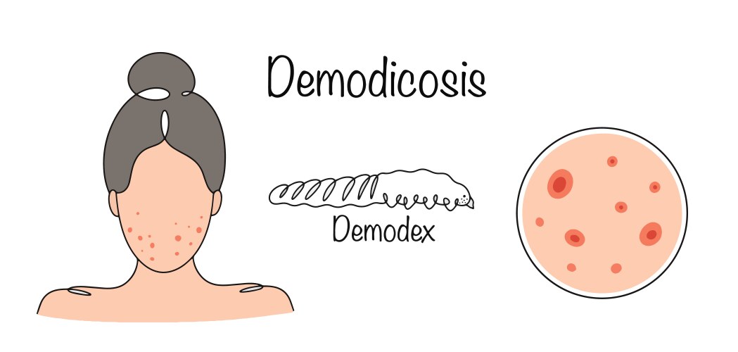 Heat rash Royalty Free Vector Image - VectorStock