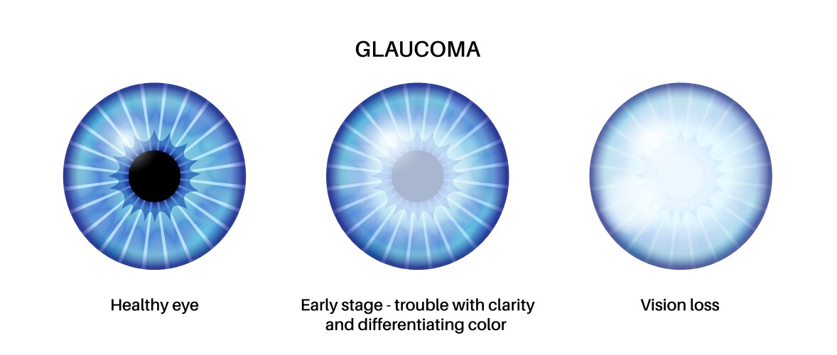 Glaucoma eye disease Royalty Free Vector Image