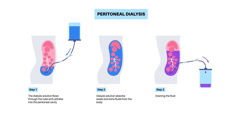 Peritoneal Dialysis Vector Images (44)