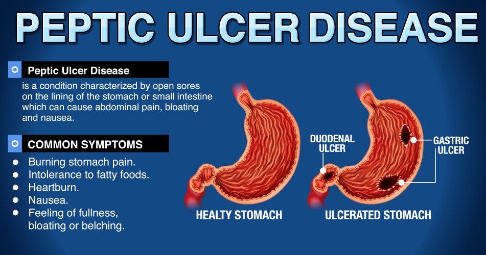 Peptic ulcer disease infographic Royalty Free Vector Image