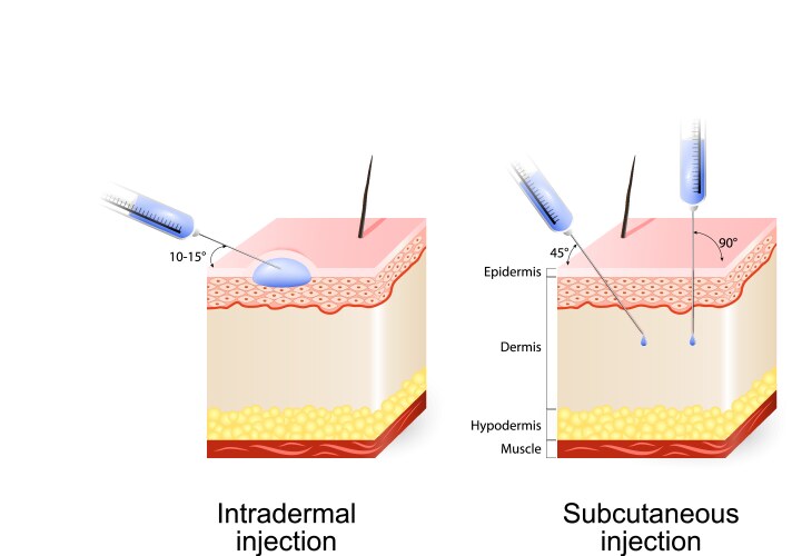 Cortisone injection shoulder injury diagram Vector Image