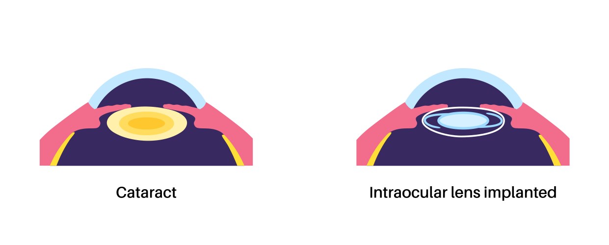 Intraocular lenses poster Royalty Free Vector Image