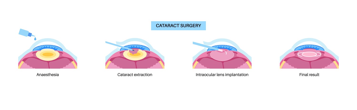 Cataract surgery poster Royalty Free Vector Image