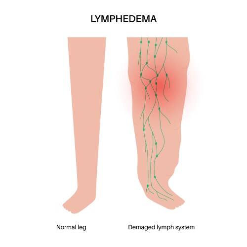 Lymphedema Swelling Legs Edema Icon Royalty Free Vector