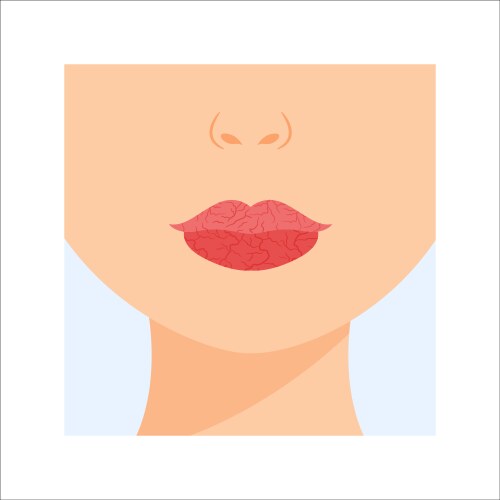 Cracked Lips Vector Images (over 120)