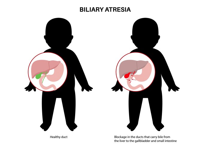 Biliary atresia disease Royalty Free Vector Image