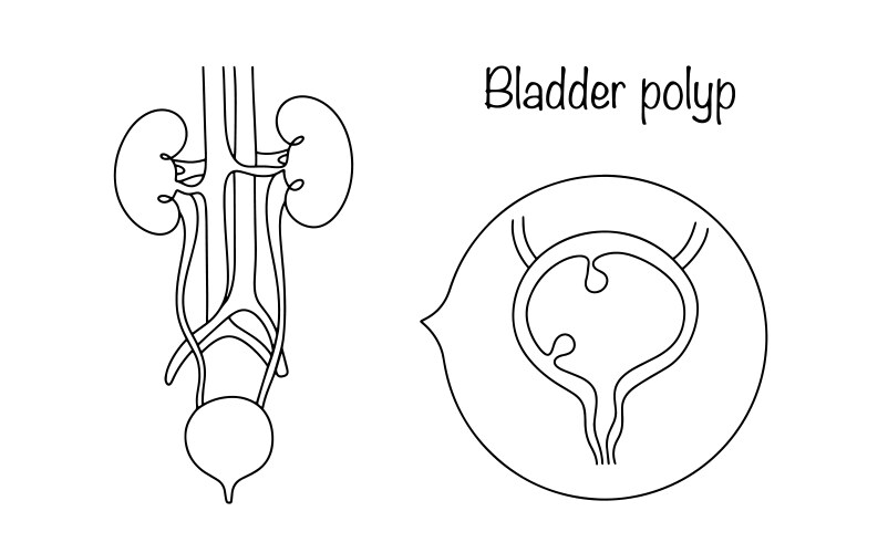 Bladder hyperactivity Royalty Free Vector Image