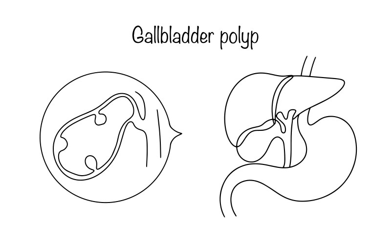 Bladder polyp Royalty Free Vector Image - VectorStock