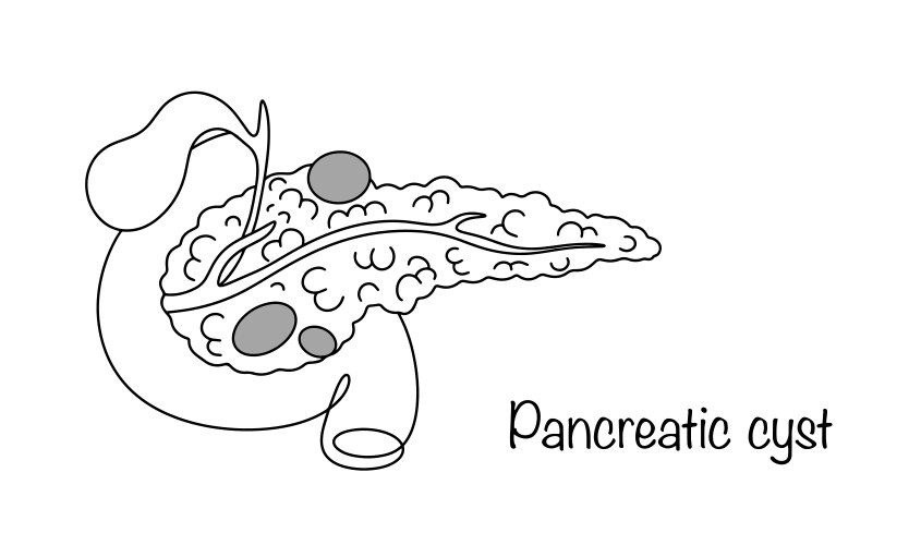 Liver cyst Royalty Free Vector Image - VectorStock
