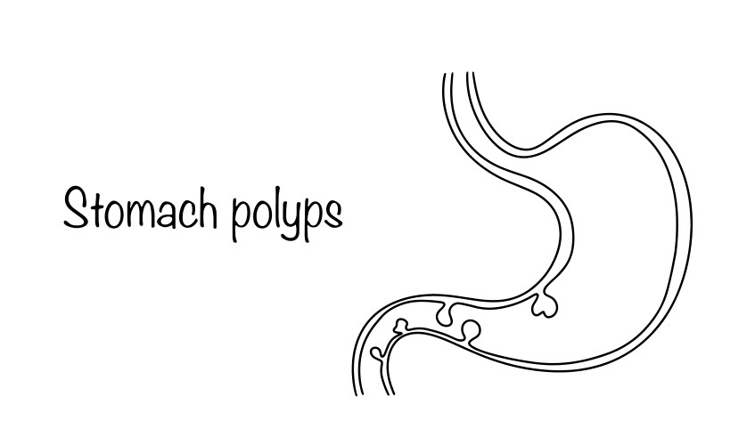 Nasal polyps Royalty Free Vector Image - VectorStock