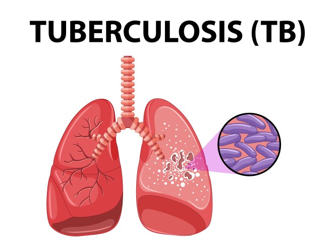 Tuberculosis Cartoon Vector Images (over 880)