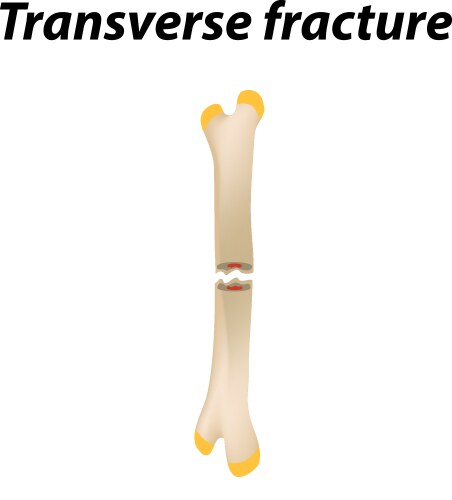 Stages of healing bone fracture formation Vector Image