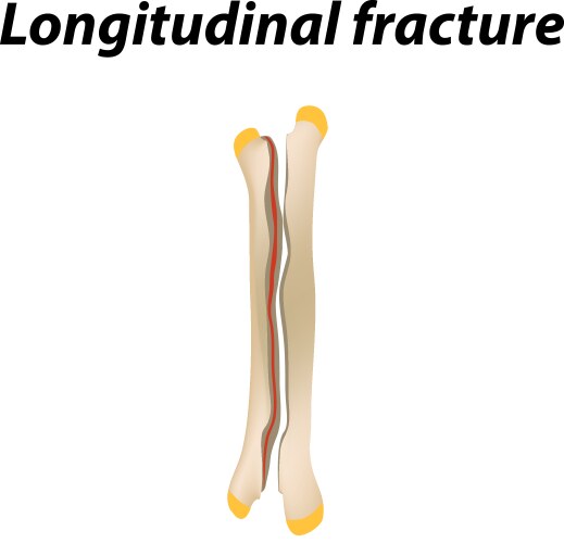 Segmental fracture bone infographics Royalty Free Vector