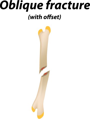 Oblique Fracture Vector Images (over 100)