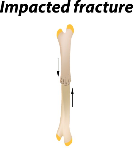 Bone Fracture Types Vector Images (over 130)