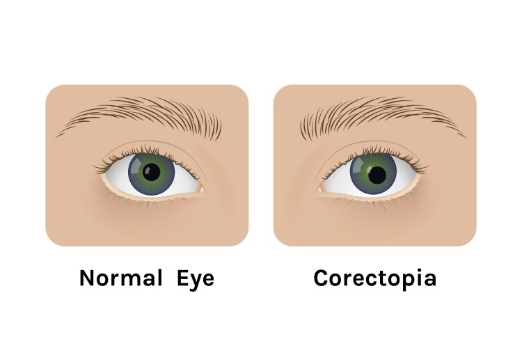 Realistic human normal eyes and with colomba Vector Image