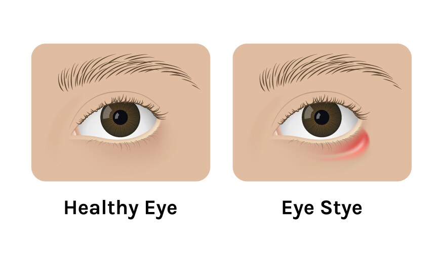 Realistic human healthy eye and with glaucoma Vector Image