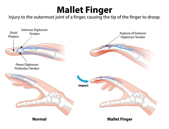 Diagram explaining trigger finger condition and Vector Image