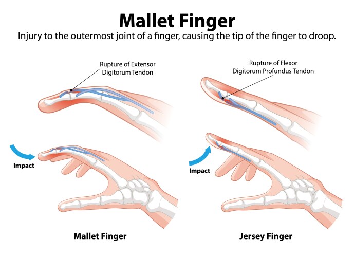 Finger tendon injuries and normal anatomy Vector Image