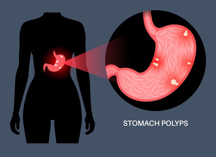 Stomach polyp disease Royalty Free Vector Image