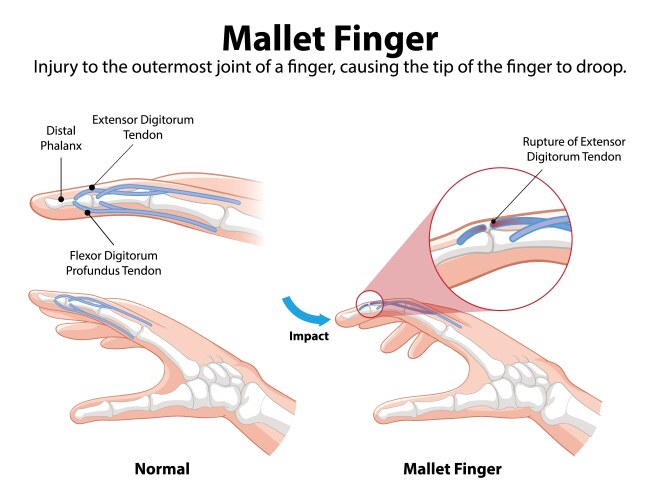 Diagram showing normal and mallet finger Vector Image