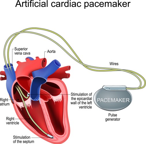 Pacemaker Vector Images (over 870)