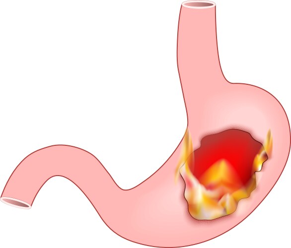 Heartburn Vector Images (over 2,400)