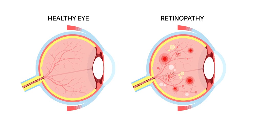 Diabetes related retinopathy Royalty Free Vector Image