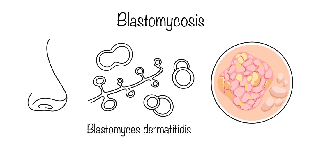 Heat rash Royalty Free Vector Image - VectorStock