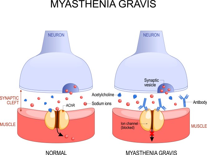 Myasthenia Gravis Vector Images (95)