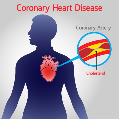 Coronary artery disease icon Royalty Free Vector Image