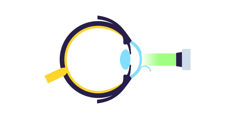 Lasik eye surgery Royalty Free Vector Image - VectorStock