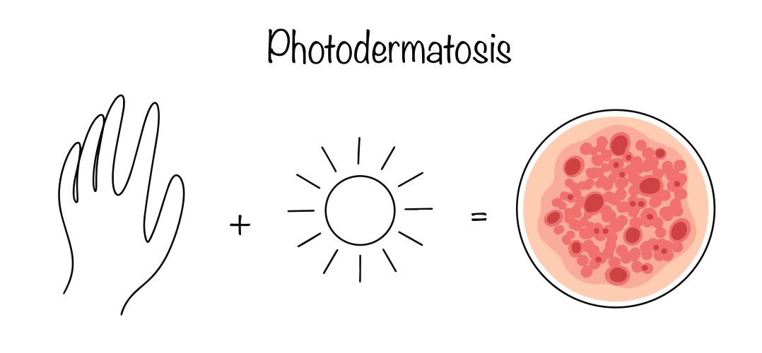Heat rash Royalty Free Vector Image - VectorStock