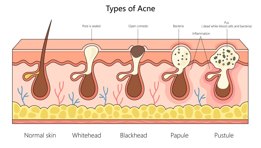 Acne Diagram Skin Purging Vs. Breakout How To Tell The Difference