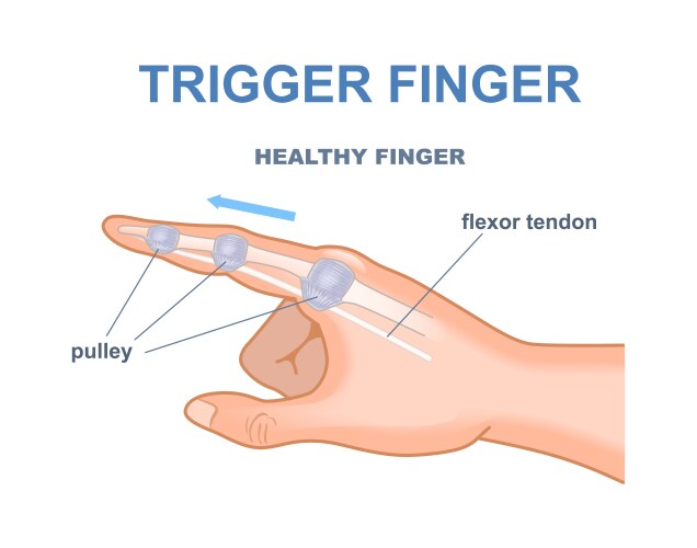 Trigger Finger Anatomy Diagram Royalty Free Vector Image